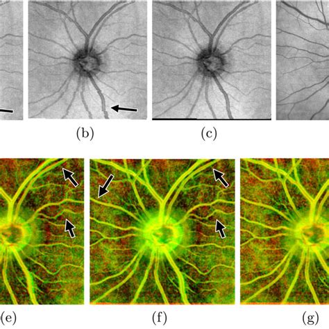 Pdf Correcting Motion Artifacts In Retinal Spectral Domain Optical Coherence Tomography Via