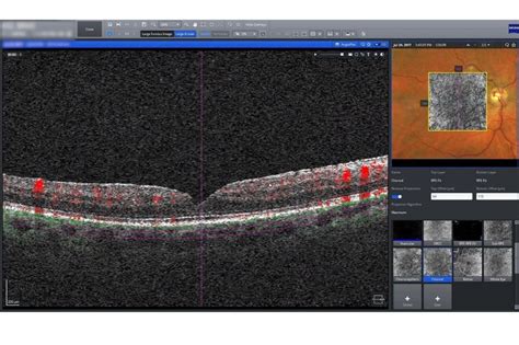 The Future Of Diabetic Retinopathy Management With Artificial Intelligence And Diagnostic Imaging