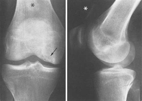 Joint And Soft Tissue Calcification Musculoskeletal Key