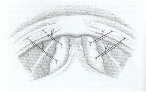 Figure 1 From Safety And Efficacy Of Laparoscopic Colposuspension