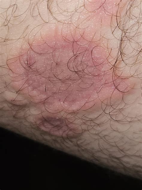Inner Thigh Rash Rdermatologyquestions