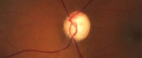 Optic Nerve Glaucoma