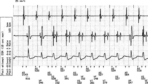 Electrocardiographic Follow‐up Of Biventricular Pacemakers Pmc