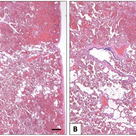 Autopsy Section From The Lung Shows Alveolar Filling And Expansion By