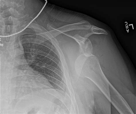 Regional Anesthesia Interscalene Block