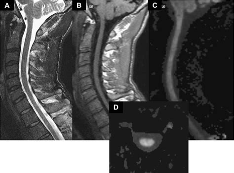 Figure 1 From Diffusion Weighted Imaging Diffusion Tensor Imaging And Fiber Tractography Of