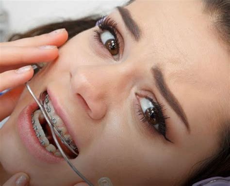 What Does Braces Headgear Do At Tina Wall Blog