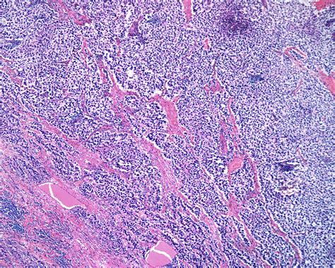 Neurodevelopmental Disorders And Risk Of Seminoma Gu Oncology Now