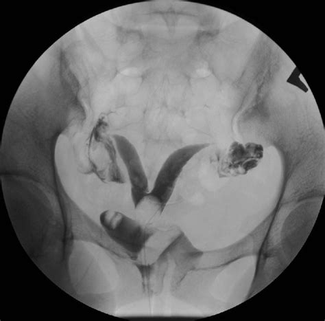 Hysterosalpingogram Pacs