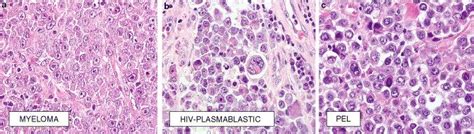 Extramedulary Involvement By Multiple Myeloma Case A11 Contributed By Download Scientific