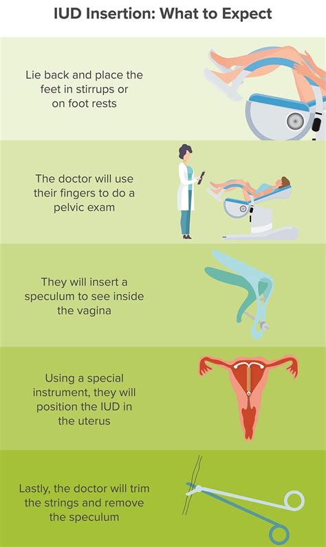What To Expect During Iud Insertion Vistasol Medical Group