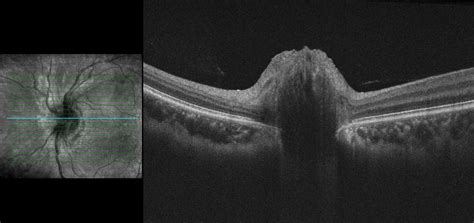 Atlas Entry Idiopathic Intracranial Hypertension Iih