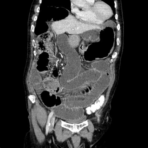 File Small Bowel Volvulus Causing Small Bowel Obstruction Mimicking Intussusception
