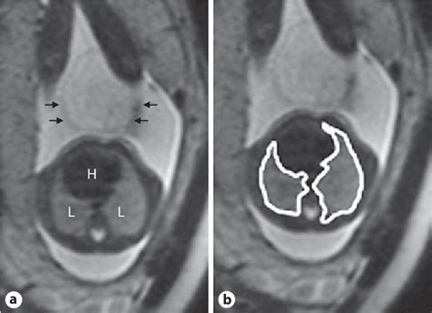 Figure 1 From Fetal Mri Calculated Total Lung Volumes In The Prediction Of Short Term Outcome In