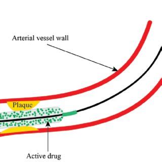 DCB Technique And Mechanism DCB Delivery Of Highly Lipophilic Drugs Download Scientific