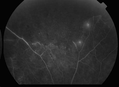 Fundus Fluorescein Angiography Showing The Presence Of Peripheral