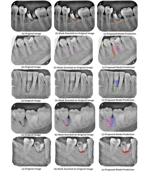 Github Anumfatima427dental Caries Segmentation This Repository