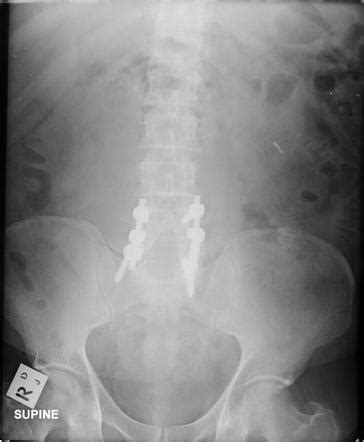 Psoas Sign