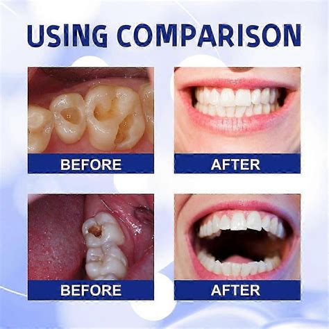 Anti Decay Toothpaste Dental Caries Repair Cream Prevent Decay Protect