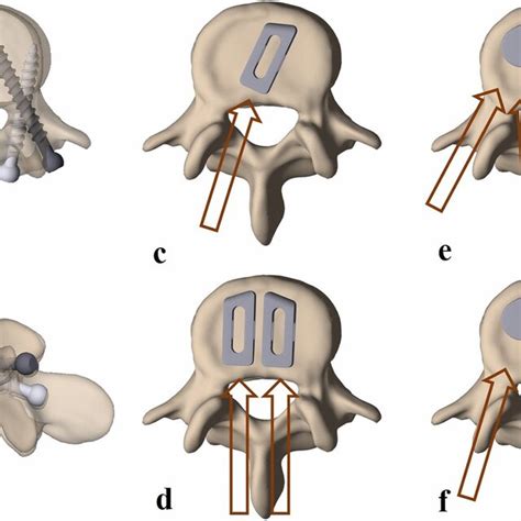 Schematic Illustration Of The Different Pedicle Screw Instrumentation