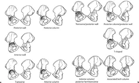 Classification Of Pelvic Ring Injuries Acetabular Fractures