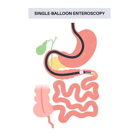 Premium Vector Single Balloon Enteroscopy Procedure Visualization Of The Small Intestine