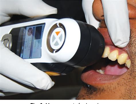 Figure 3 From Comparison Between Color Spaces Of Vita Lumin Shade Guide