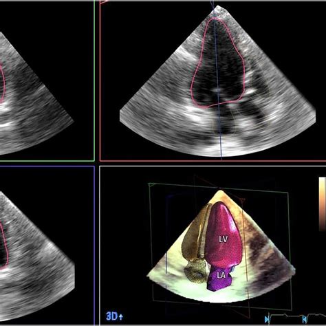 Accurate Measurement Of Left Ventricular Volumes And Left Ventricular Download Scientific