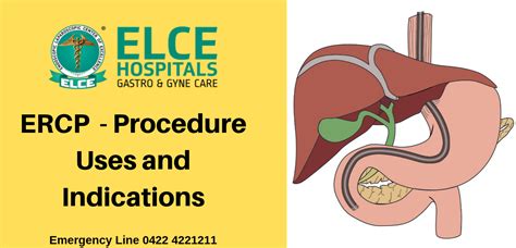 Ercp Stone Extraction