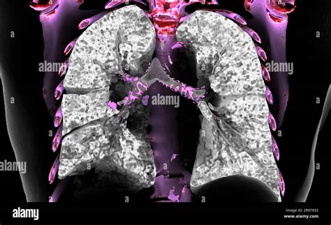 Pleural Effusion On Ct Scan