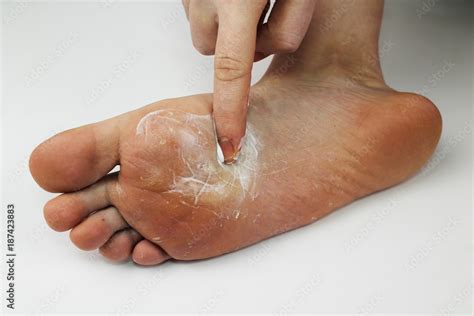 Fungus Of Foot Close Up Isolated On White Background The Concept