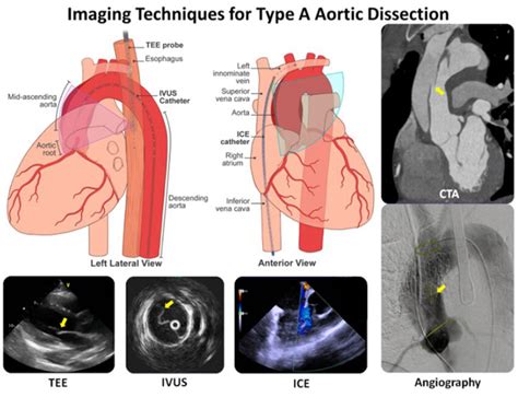Imaging Techniques For Type A Aortic Dissection Ultrasound Based