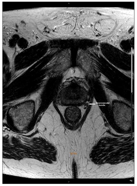 Magnetic Resonance Image Identifying The Neurovascular Bundle Download Scientific Diagram