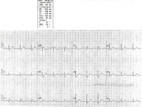 Right Bundle Branch Block Ecg Guru Instructor Resources