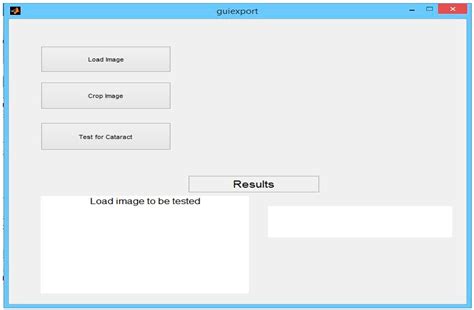 A Robust Automated Cataract Detection Algorithm Using Diagnostic Opinion Based Parameter