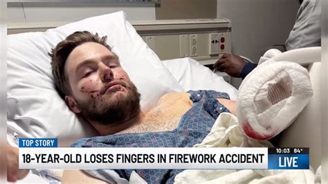 Teen Lost 3 Fingers In A ‘freak Firework Mishap — But Saved His Arm