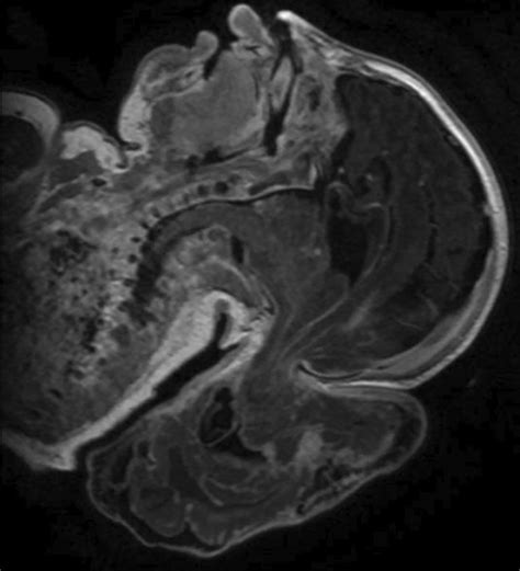 Magnetic Resonance Imaging Revealed A 1 4 Cm Calvarial Defect With A Download Scientific