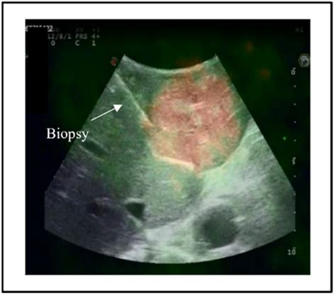 Jcm Free Full Text Functional Investigation Of The Tumoural