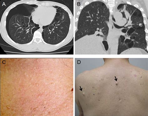 Birthoggdubé Syndrome Clinicopathological Features Of The Lung