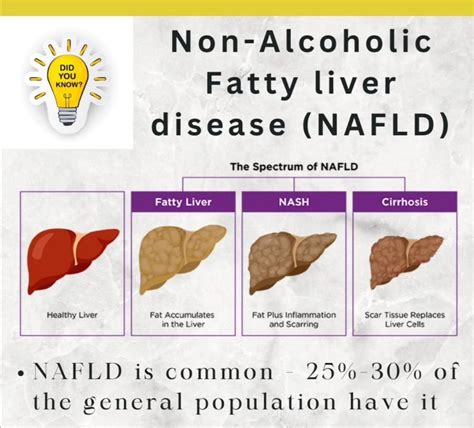 Drsandy Lee Introducing Liver Fibroscan To Primary Care