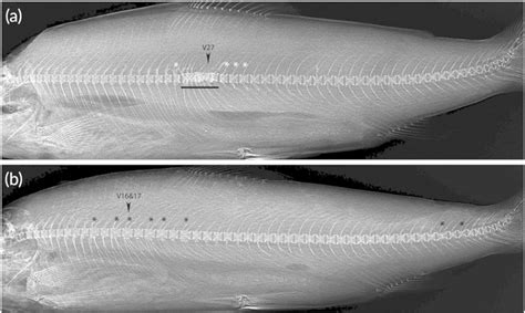 Lateral Radiography Of Vertebral Deformity Type And Location A