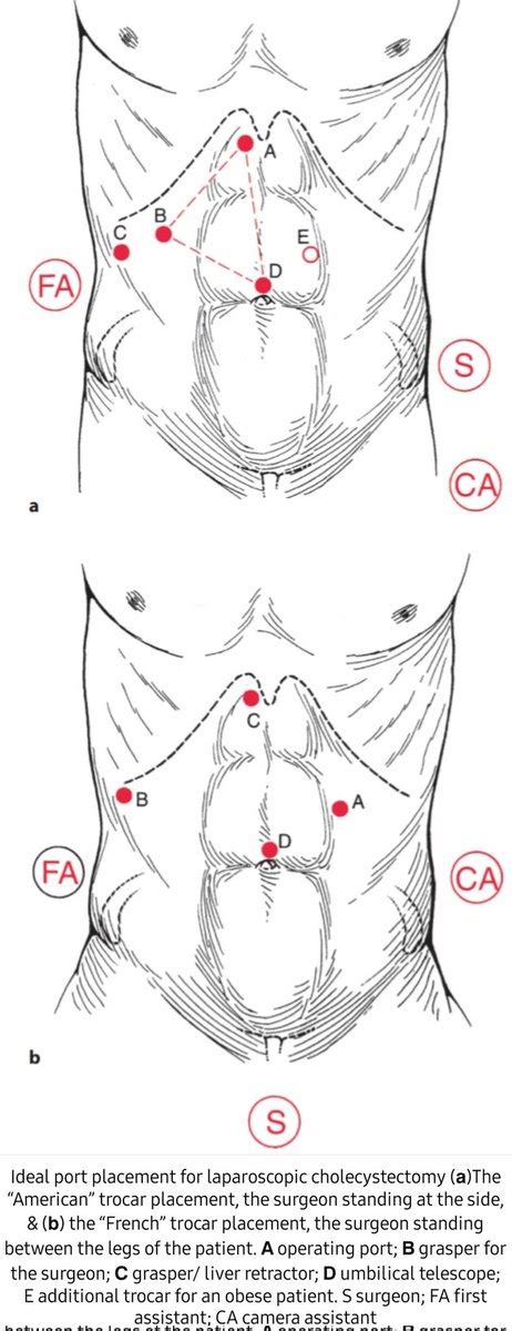 Laparoscopic Cholecystectomy Trocar Placement Techniques Of