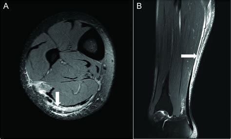 Soleus Muscle Mri Knee At Irving Sandoz Blog