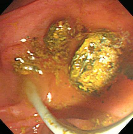 A Cholangiography Shows Filling Defects Which May Indicate Stones Download Scientific