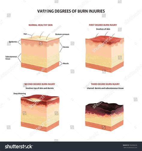Different Grades Of Burns At Karen Skillman Blog