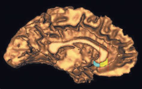 Subgenual Prefrontal Cortex Volumes In Major Depressive Disorder And