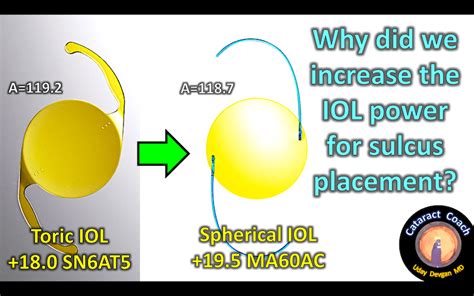 Switching From A Toric Iol To A Spherical Sulcus Iol Cataract Coach