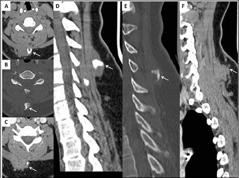 Figure 1 From Ossifying Fibromyxoid Tumor With Spinal Cord Compression