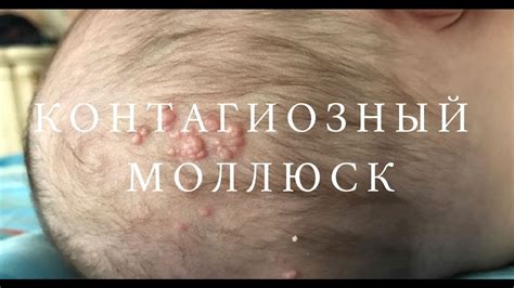 Контагиозный моллюск Youtube