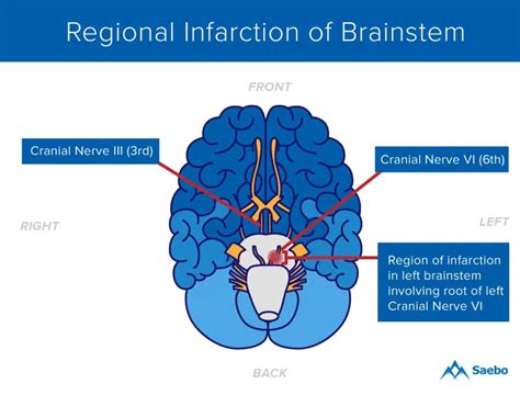What Is A Brainstem Stroke Zao Rehab